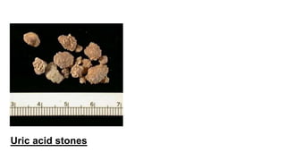 Renal stone diseases - General Medicine - RDT | PPTX