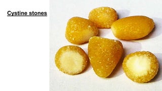 Renal stone diseases - General Medicine - RDT | PPT