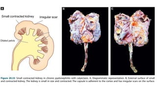 Pyelonephritis, Tuberculous pyelonephritis - Pathology | PPTX