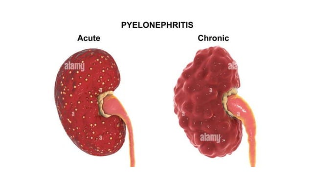 Pyelonephritis, Tuberculous pyelonephritis - Pathology | PPTX ...