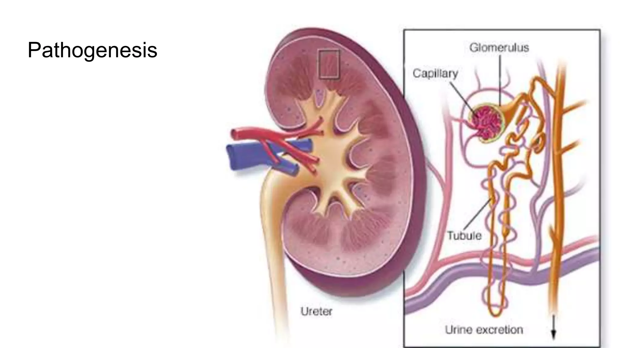 Nephrotic syndrome - Pathology - RDT | PPTX
