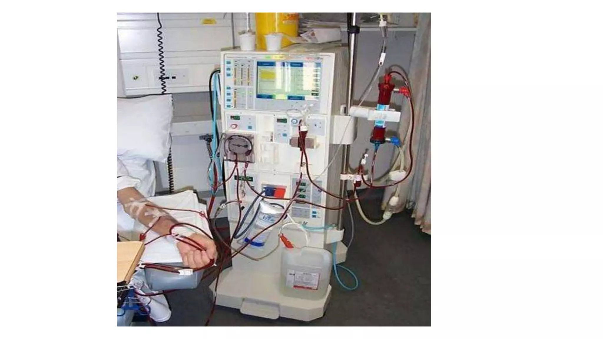 End-Stage Kidney Disease - Pathology - RDT | PPTX