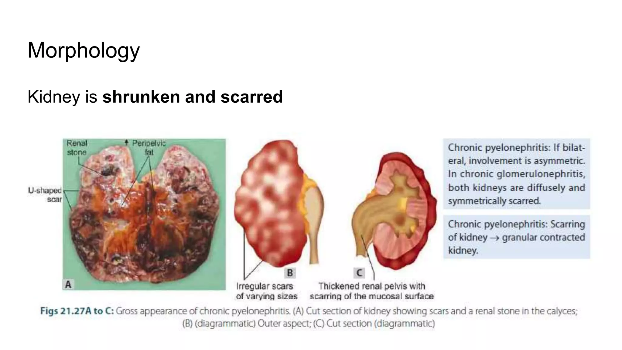 Classification of Renal Diseases, Acute Tubular Necrosis, Acute ...