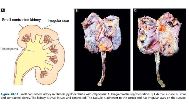 Classification of Renal Diseases, Acute Tubular Necrosis, Acute ...