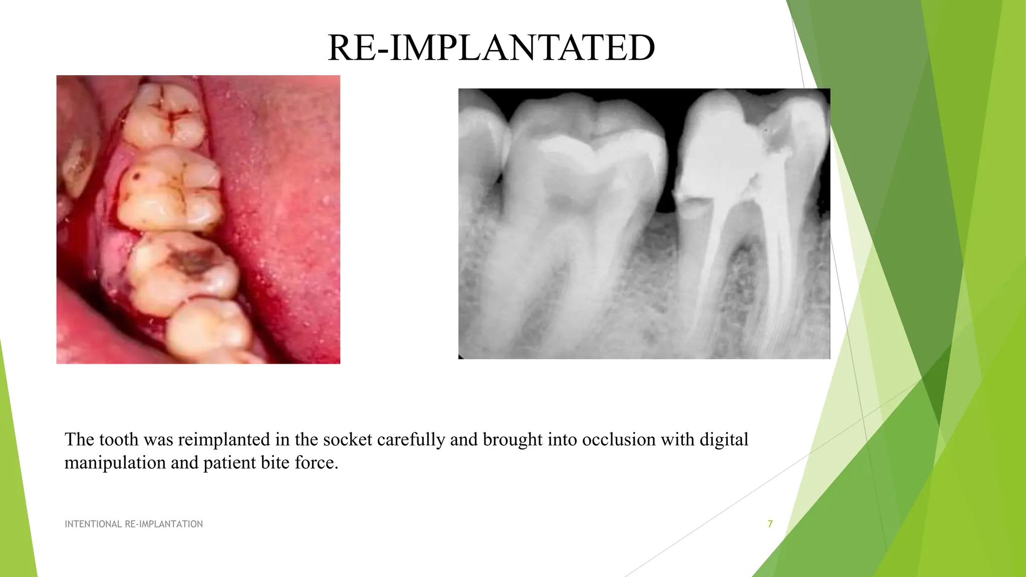 Re-implantationgoodforendodonticsss.pptx