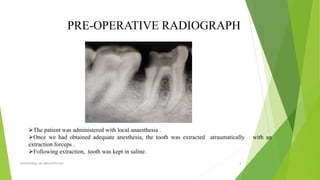 Re-implantationgoodforendodonticsss.pptx