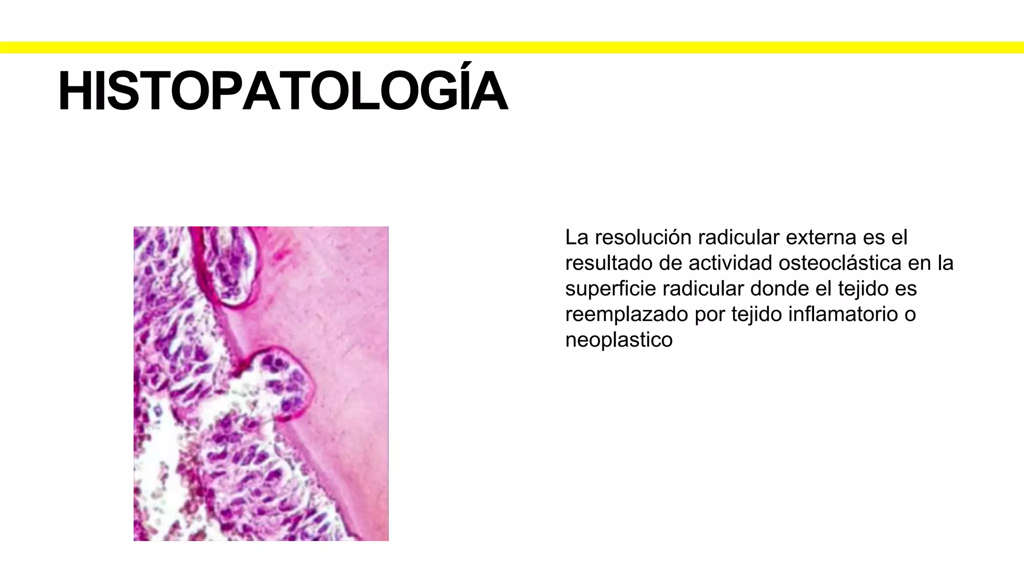 Reabsorción radicular externa .pptx