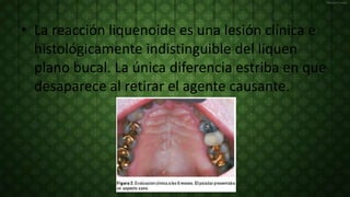 Reacciones liquenoides en cavidad Oral | PPTX