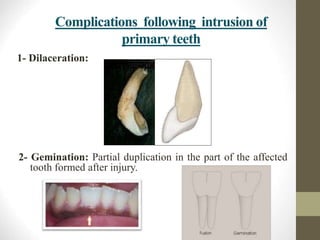 Reaction of teeth to trauma | PPT