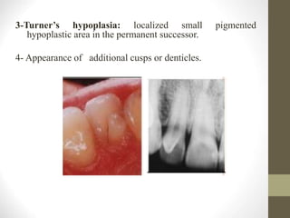 Reaction of teeth to trauma | PPT
