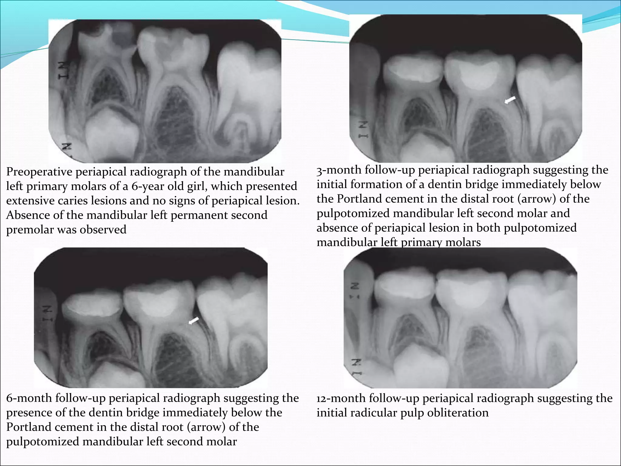 Reaction of the pulp to various capping materials 2003 | PPT