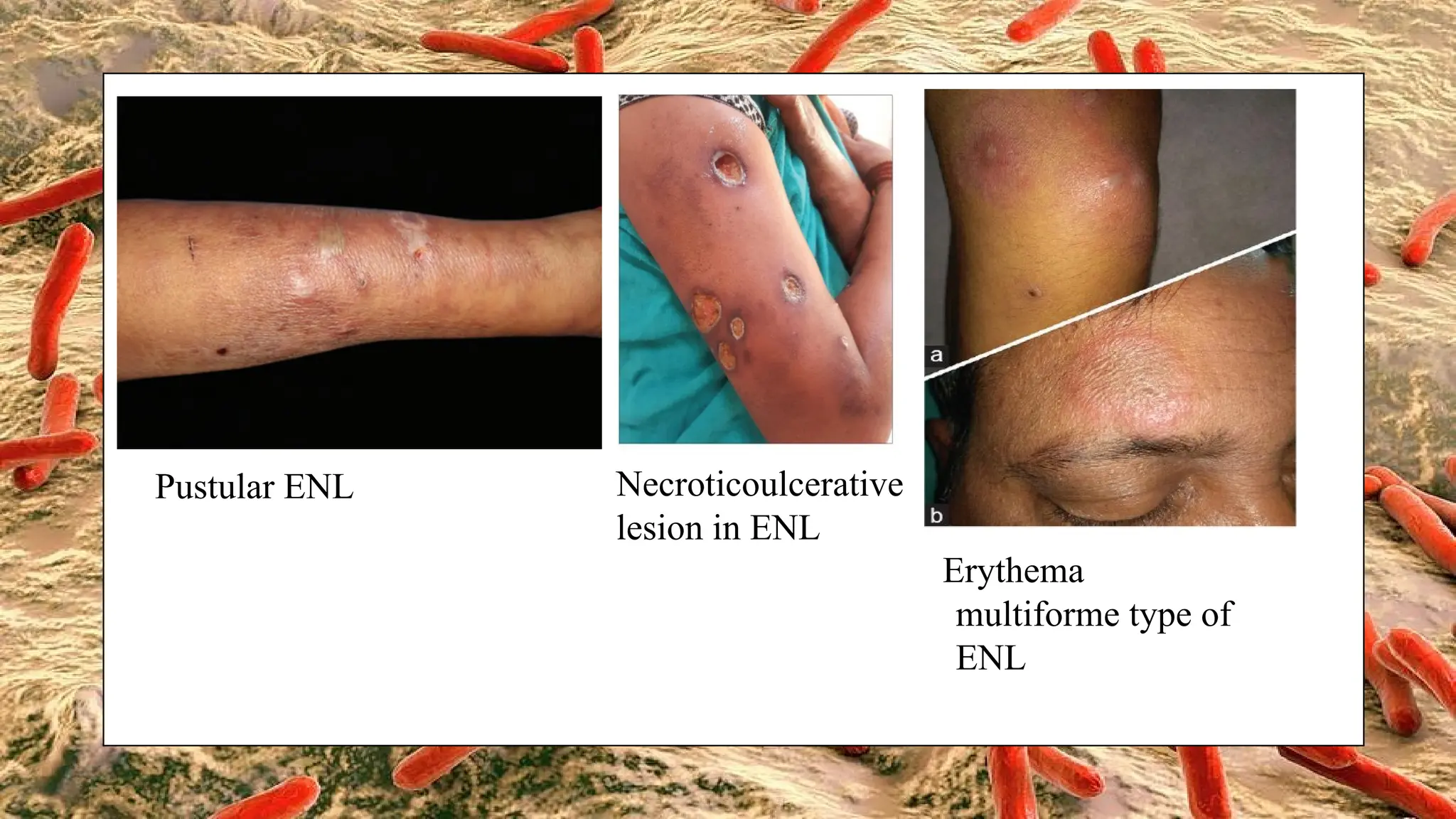 Reactions in leprosy - Type 1 Type 2 reactions | PPT