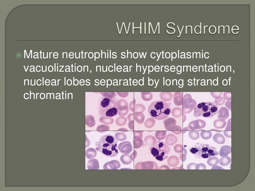 Reactive Atypical Abnormal Morphology of neutrophils
