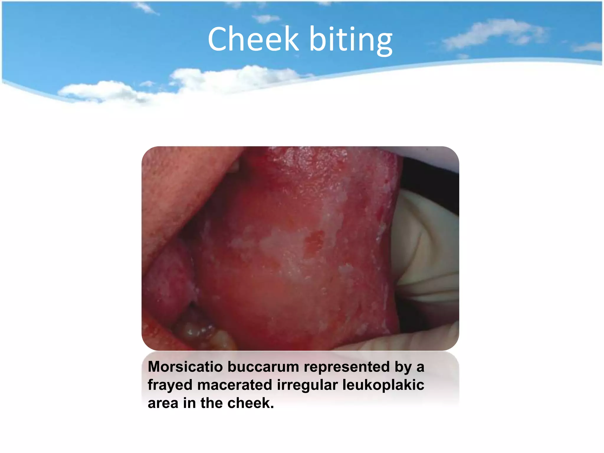 Reactive white lesions oral pathology | PPTX
