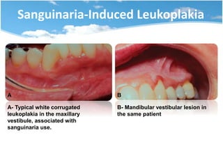 Reactive white lesions oral pathology | PPTX