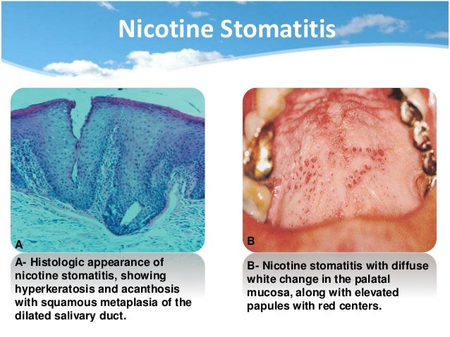 Reactive white lesions oral pathology
