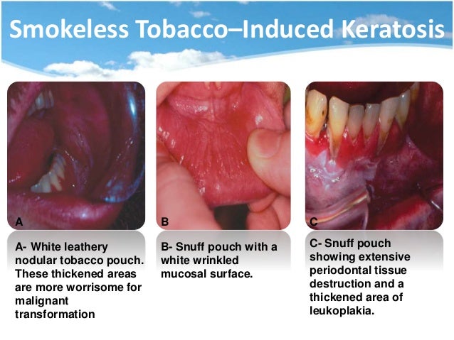Reactive white lesions oral pathology