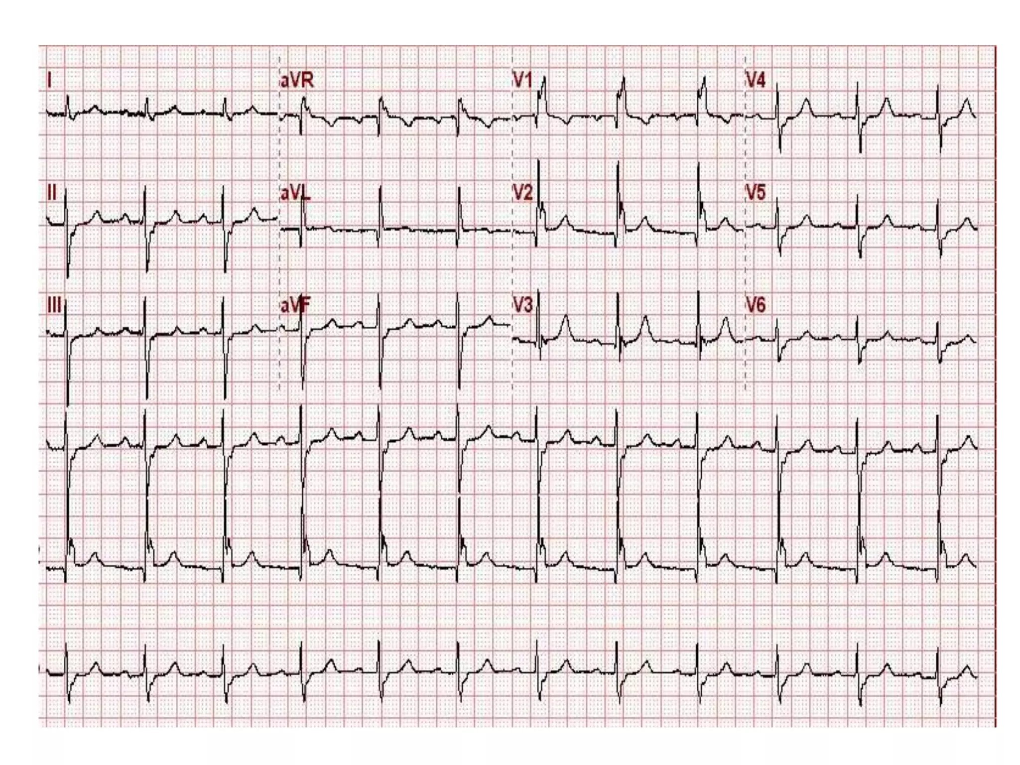 ECG reading | PPTX