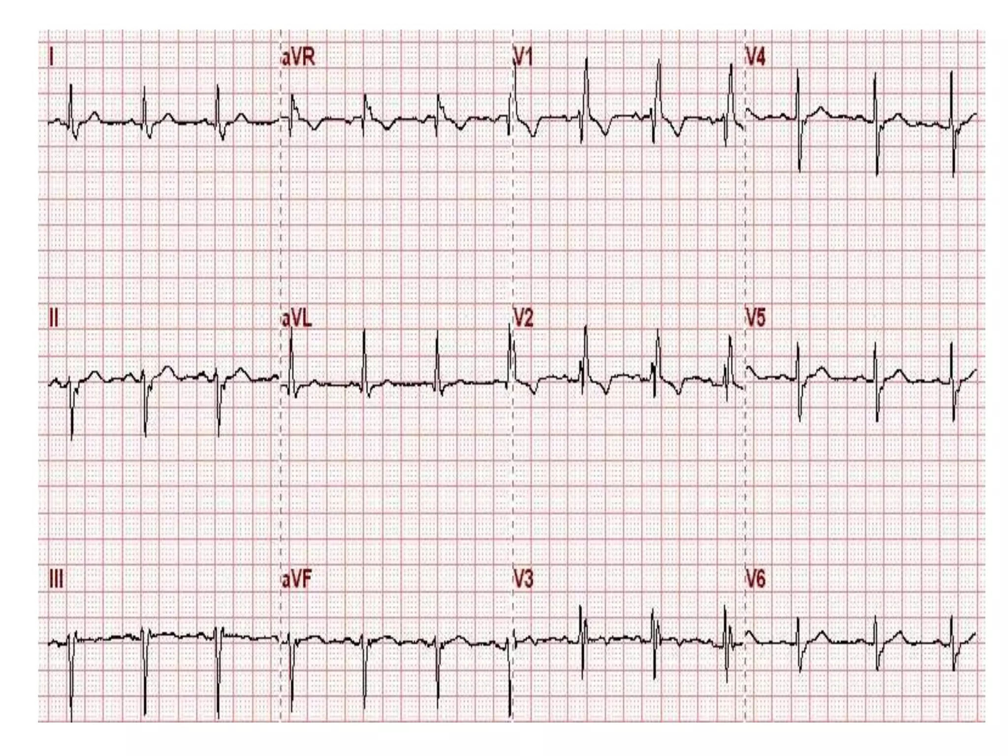 ECG reading | PPTX