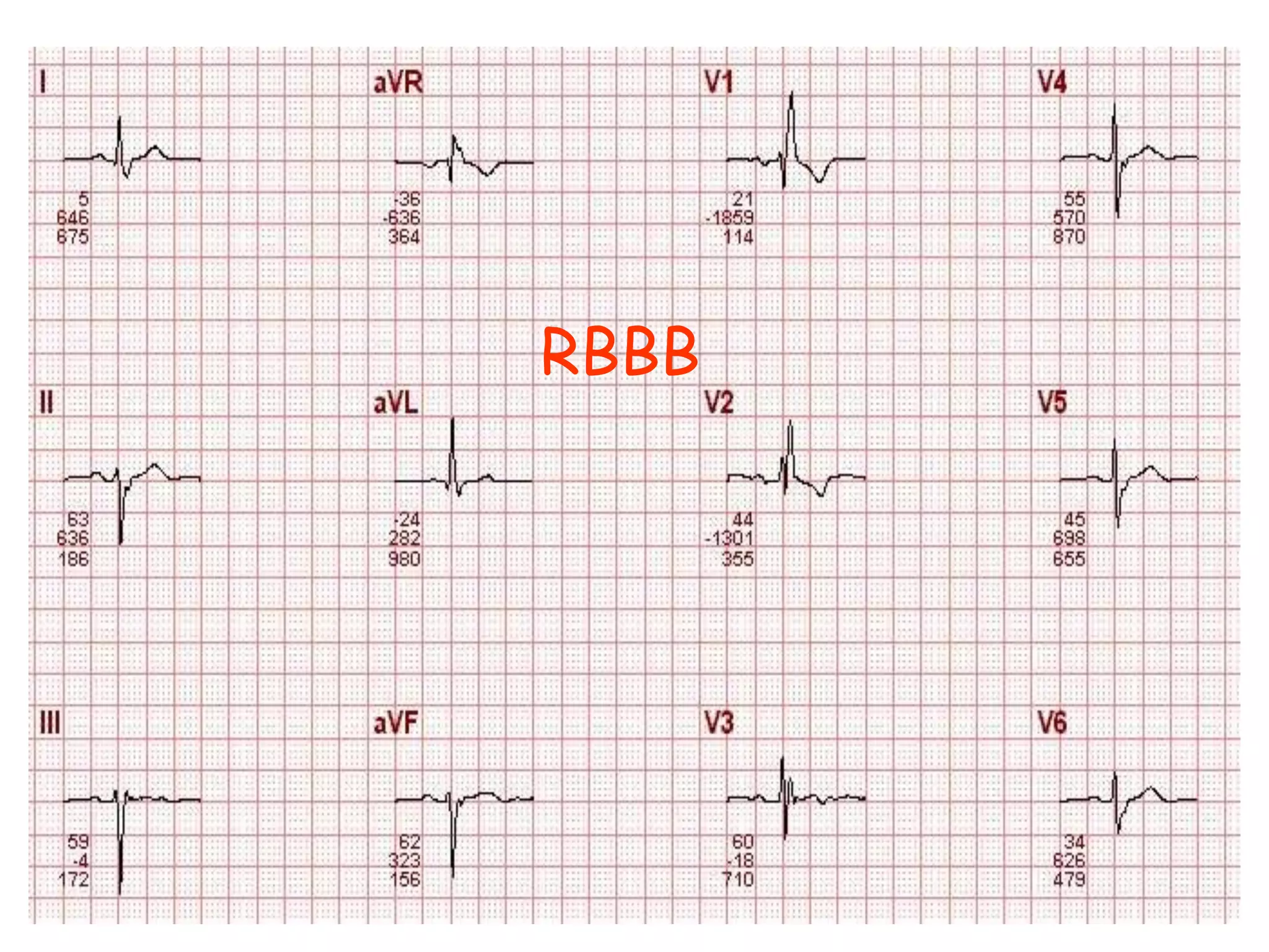 ECG reading | PPTX