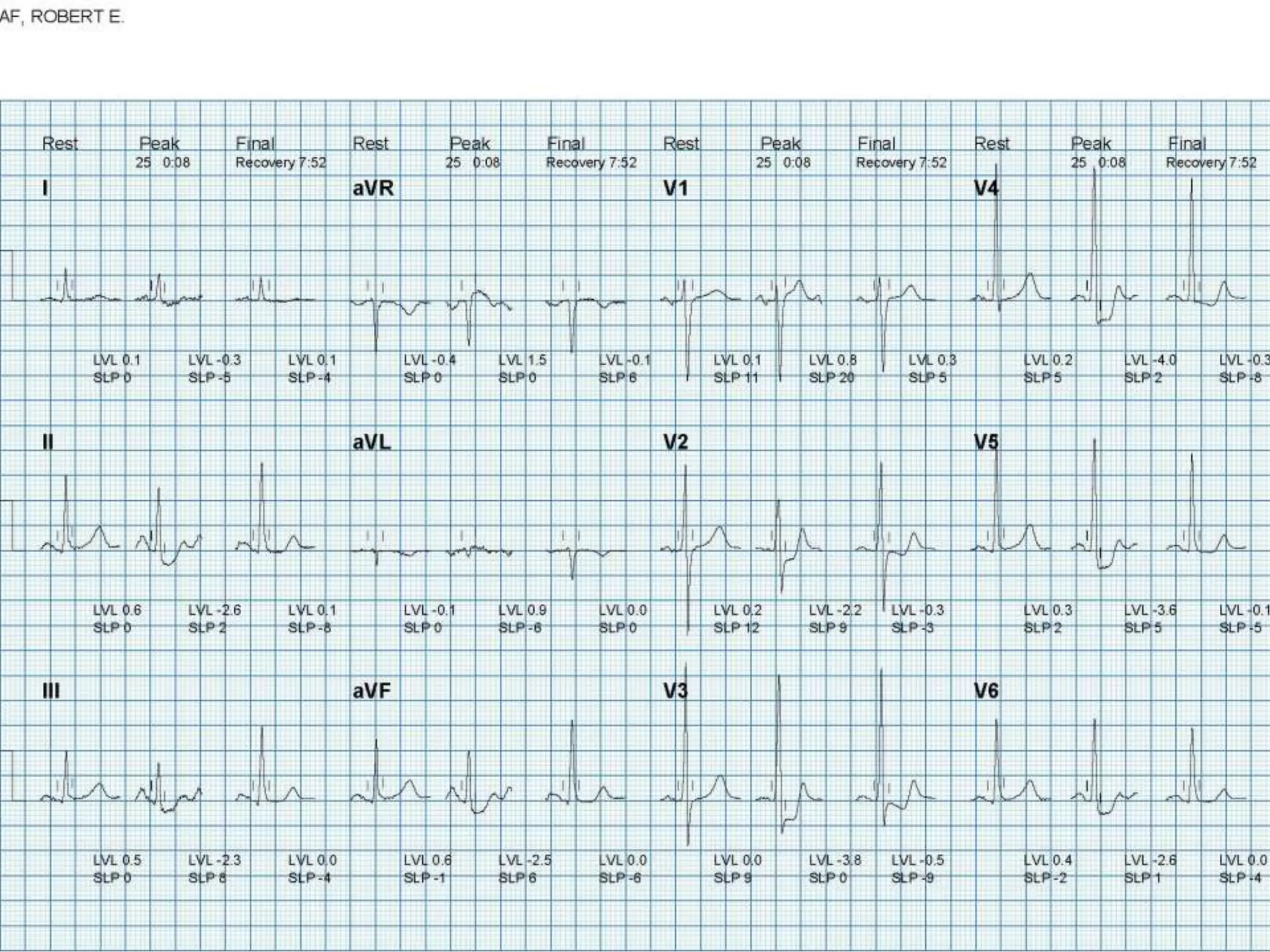 ECG reading | PPTX