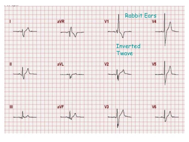 ECG reading