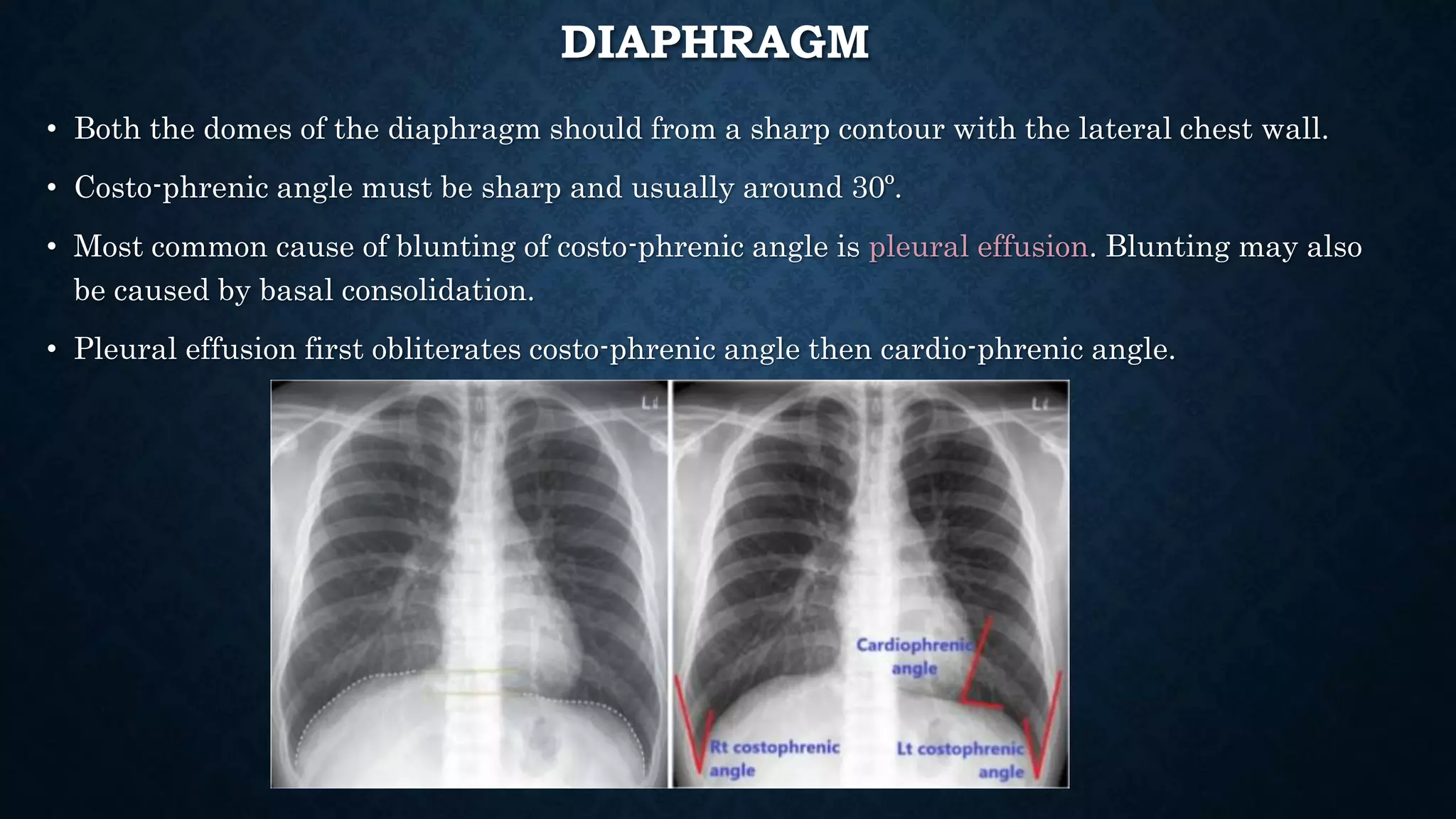 Reading chest-x-rays | PPTX | Lung and Respiratory Health | Diseases and Conditions