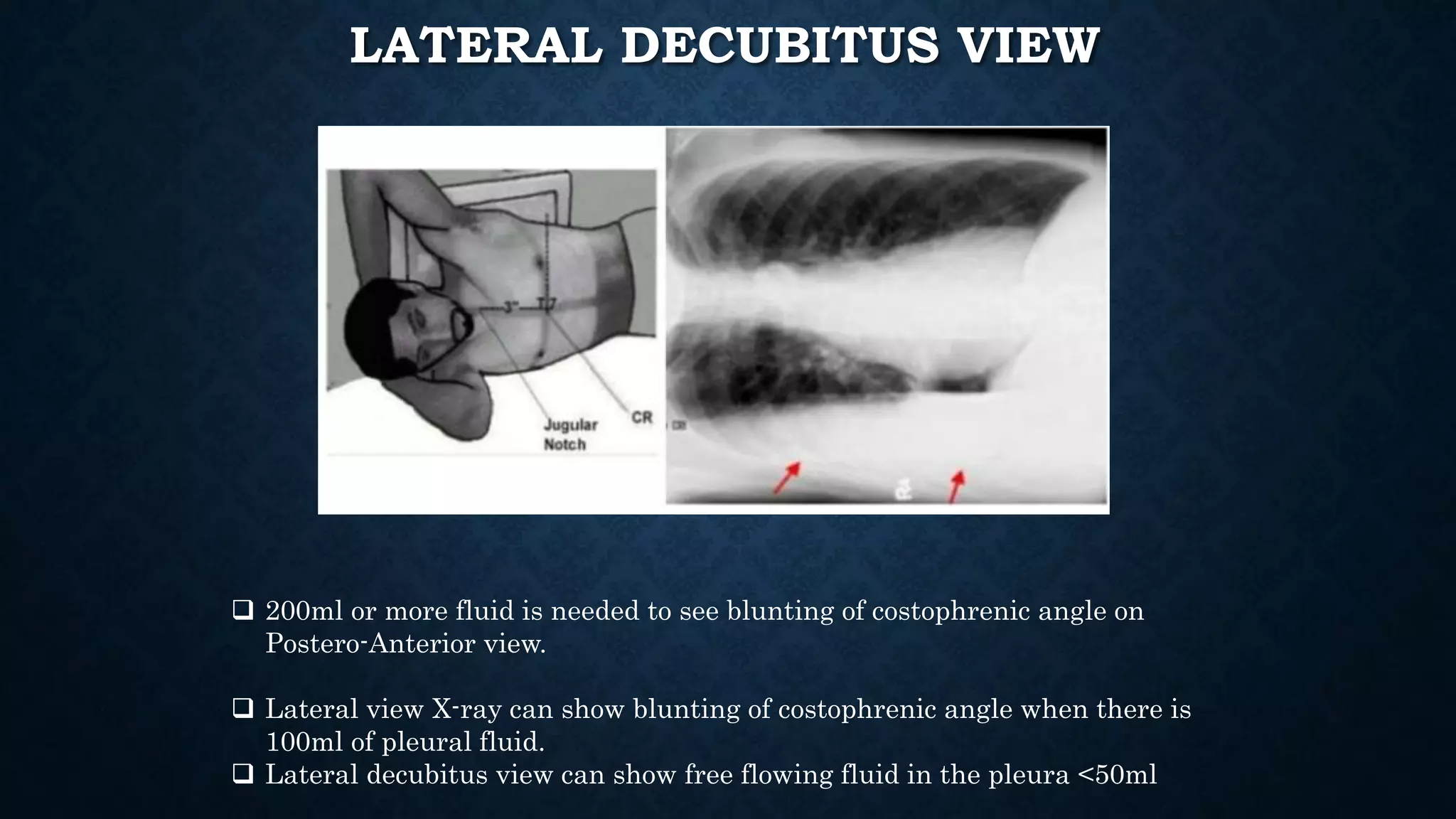Reading chest-x-rays | PPTX | Lung and Respiratory Health | Diseases ...