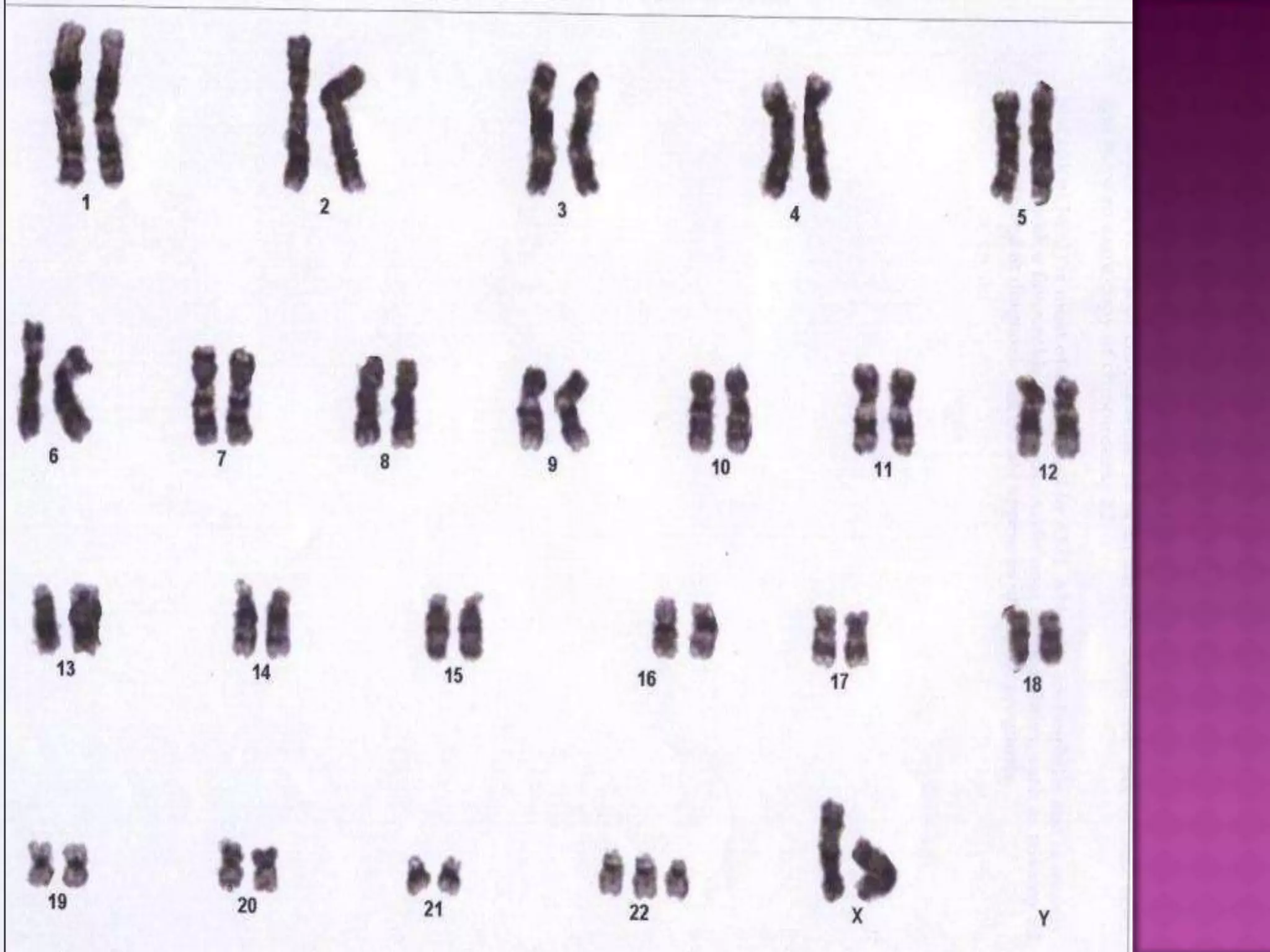 Karyotypes and Karyotyping | PPTX | Blood Disorders | Diseases and ...