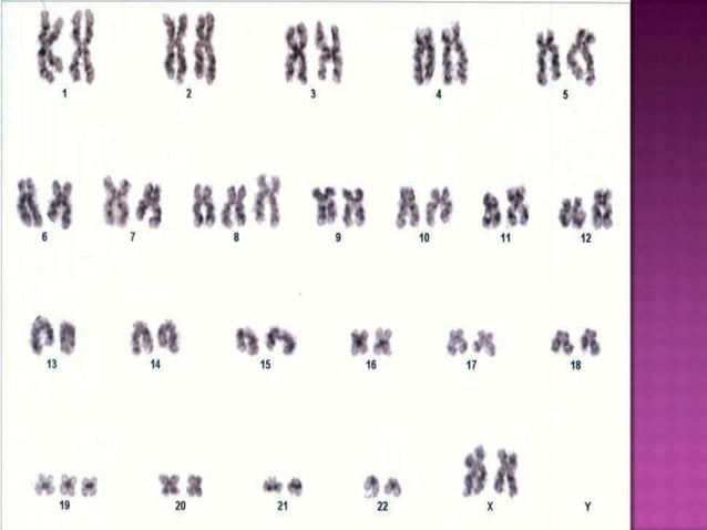 Karyotypes and Karyotyping | PPTX | Blood Disorders | Diseases and ...