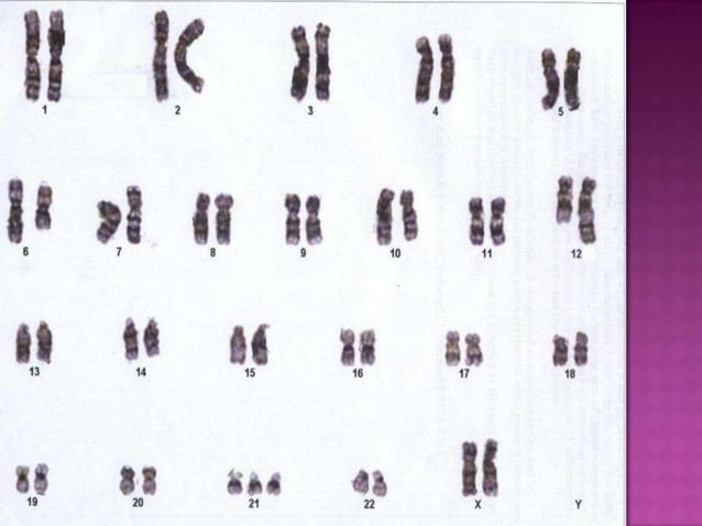 Karyotypes and Karyotyping | PPTX | Blood Disorders | Diseases and ...