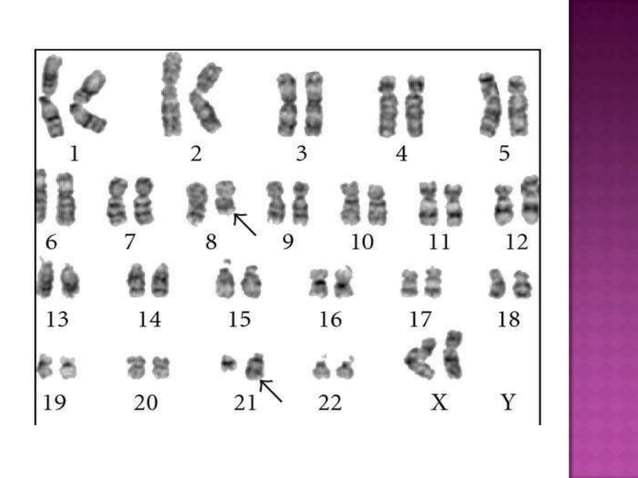 Karyotypes and Karyotyping | PPTX | Blood Disorders | Diseases and ...