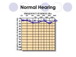 Reading an audiogram | PPT