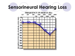 Conductive Vs Sensorineural Hearing Loss Audiogram