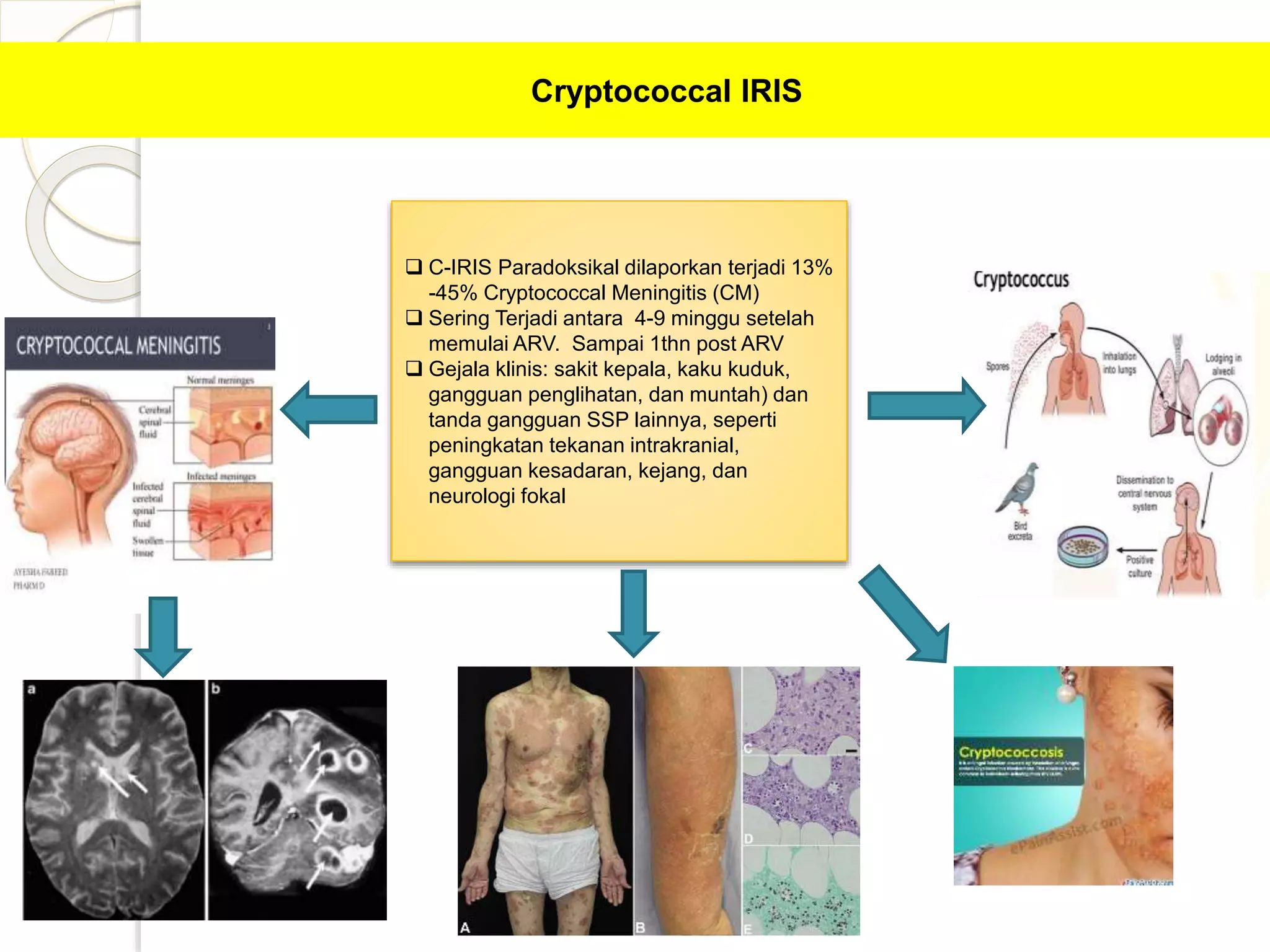 IMMUNE RECONSTITUTION INFLAMMATORY SYNDROME iris | PPTX