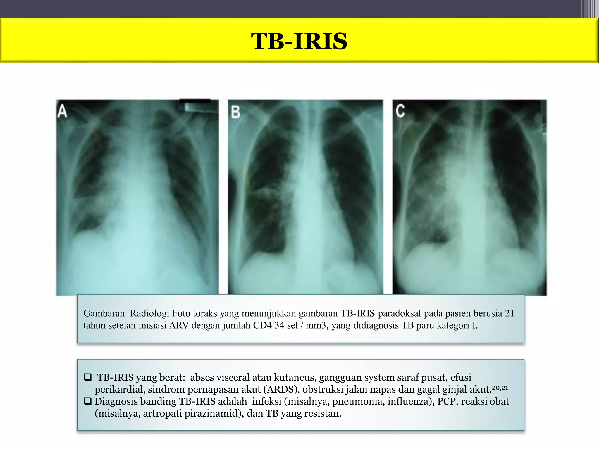 IMMUNE RECONSTITUTION INFLAMMATORY SYNDROME iris | PPTX