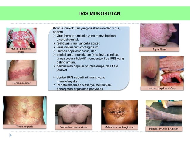IMMUNE RECONSTITUTION INFLAMMATORY SYNDROME iris | PPTX