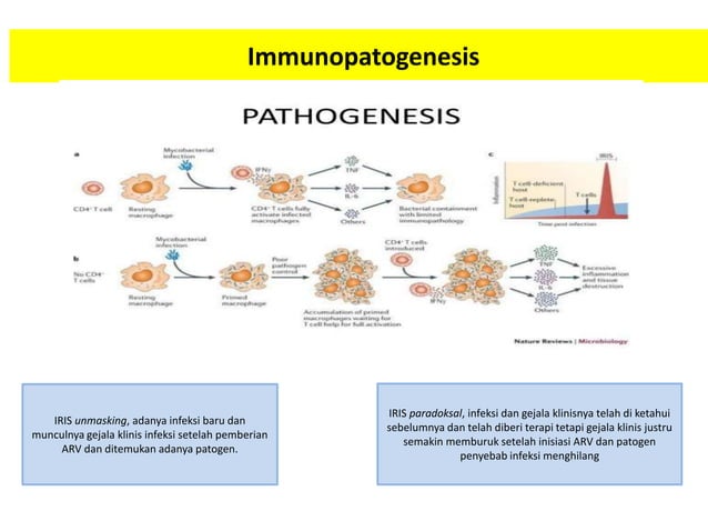 IMMUNE RECONSTITUTION INFLAMMATORY SYNDROME iris | PPTX