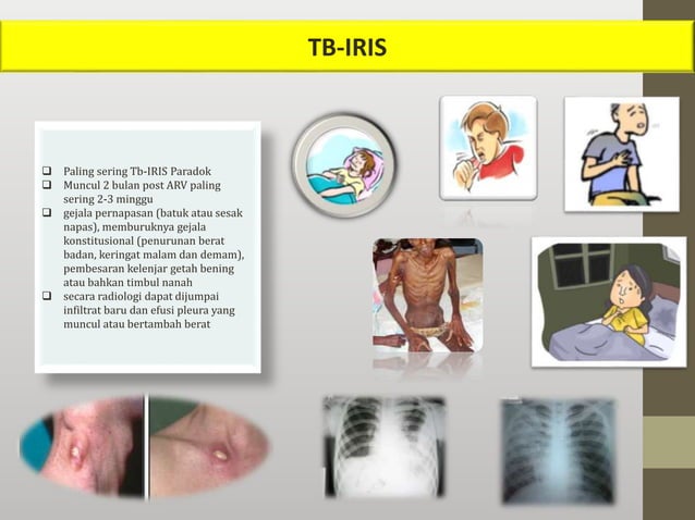 IMMUNE RECONSTITUTION INFLAMMATORY SYNDROME iris | PPTX