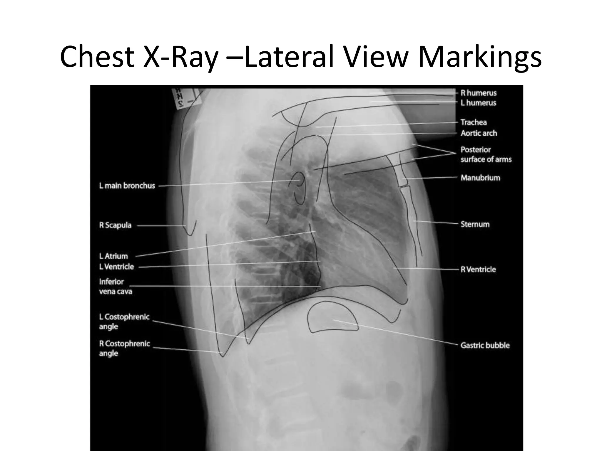 Reading chest x ray | PPT