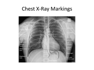 Normal Chest X Ray Labeled