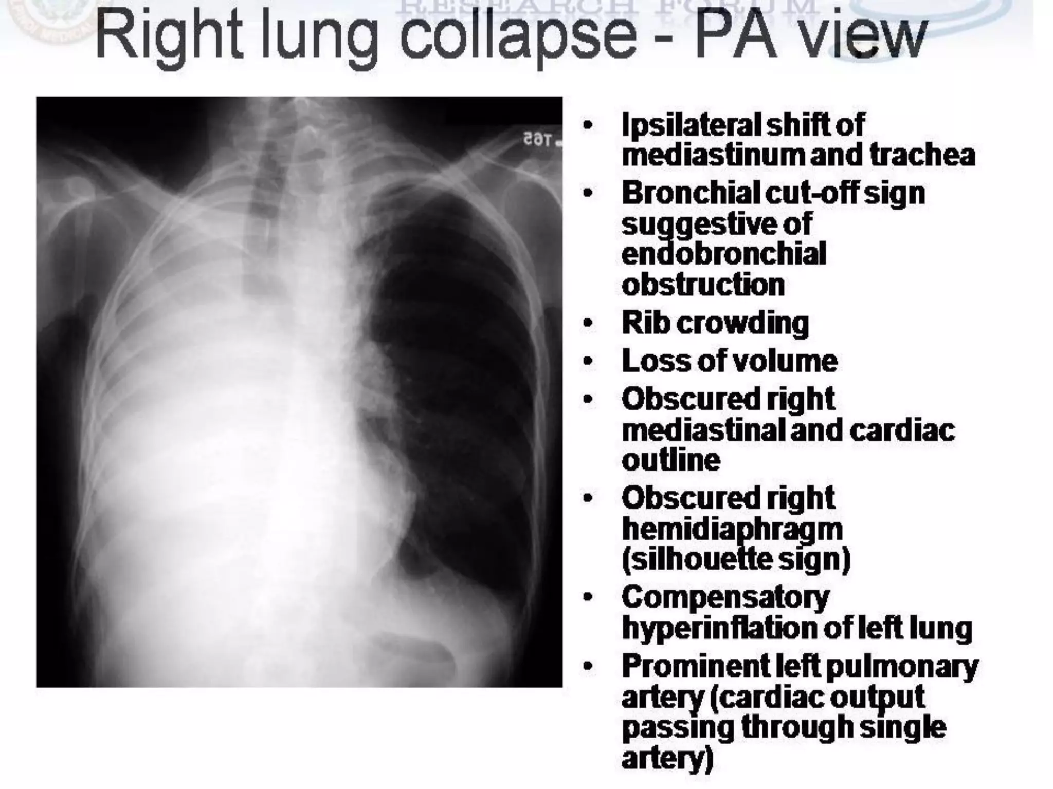 Reading chest X-ray | PDF