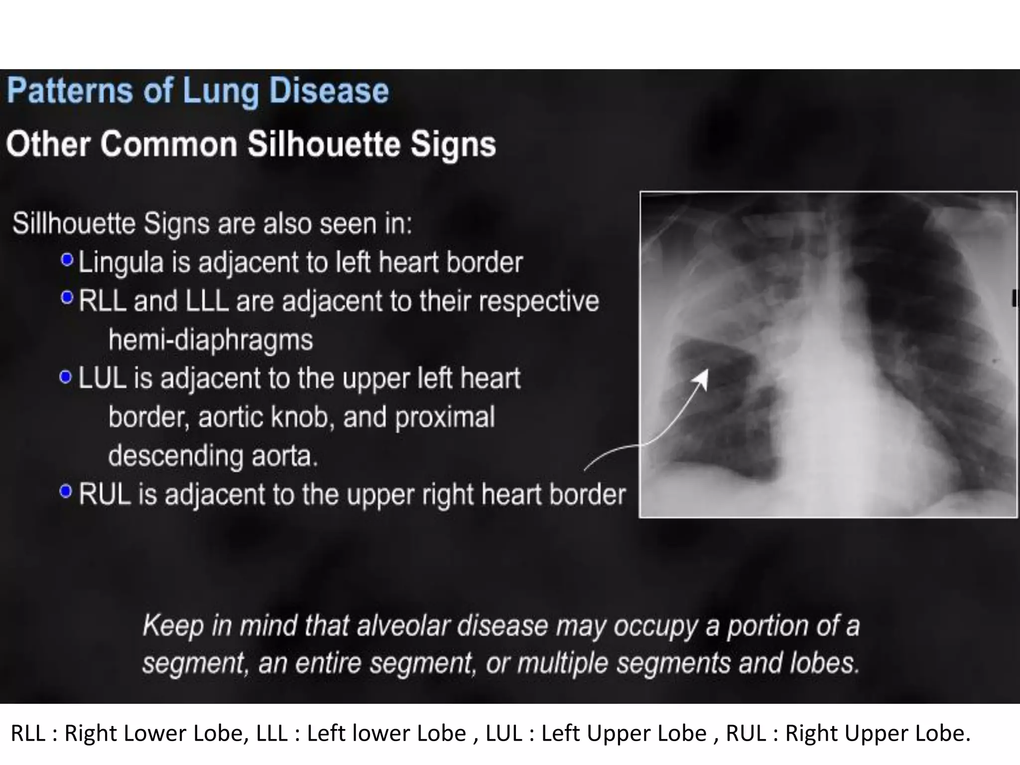 Reading chest X-ray | PDF