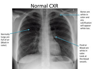 Reading chest X-ray | PPT