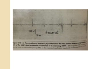 reading emg ik.pptx | Brain and Nervous System Disorders | Diseases and ...