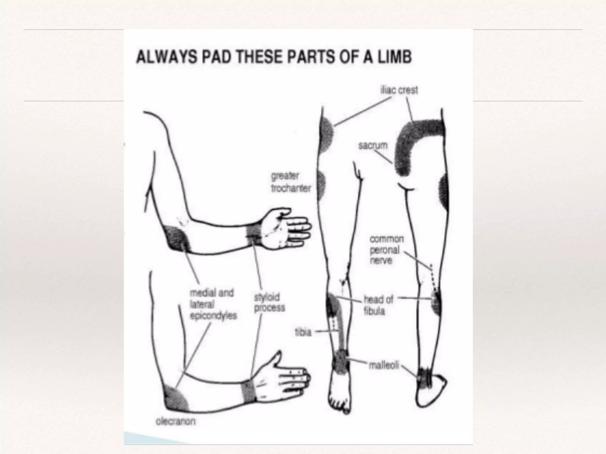 Plaster of paris in orthopaedics | PPSX