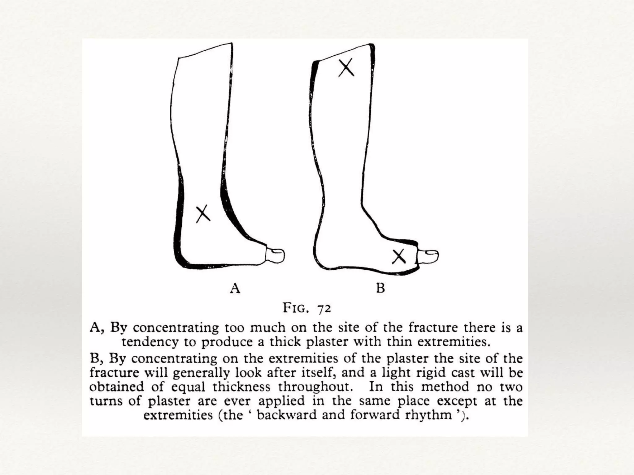 Plaster of paris in orthopaedics | PPSX