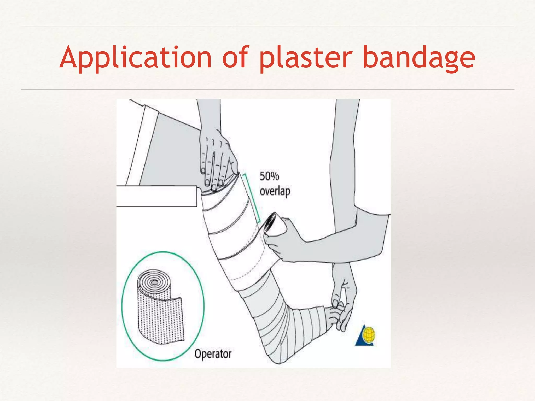 Plaster of paris in orthopaedics | PPSX