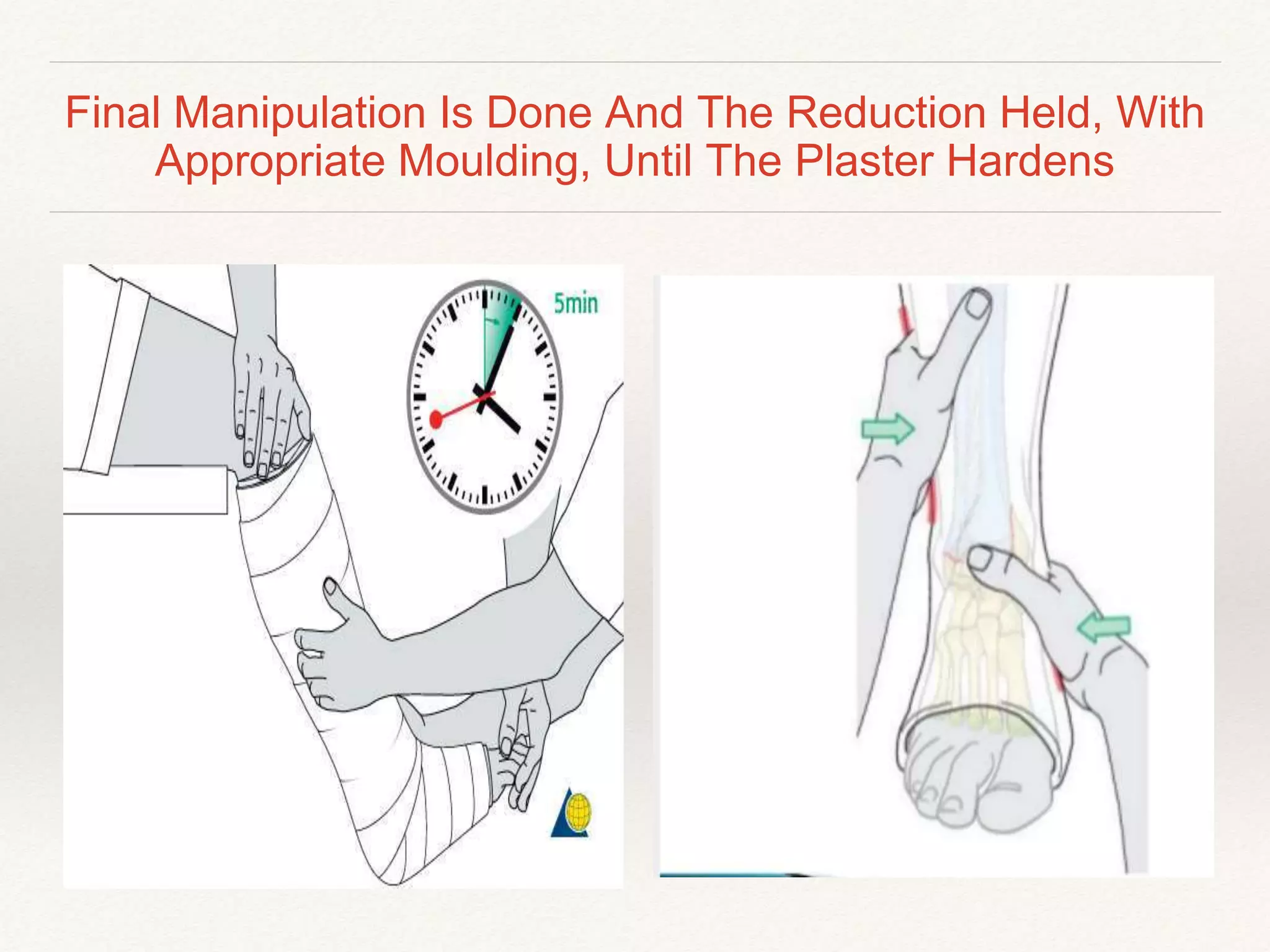 Plaster of paris in orthopaedics | PPSX