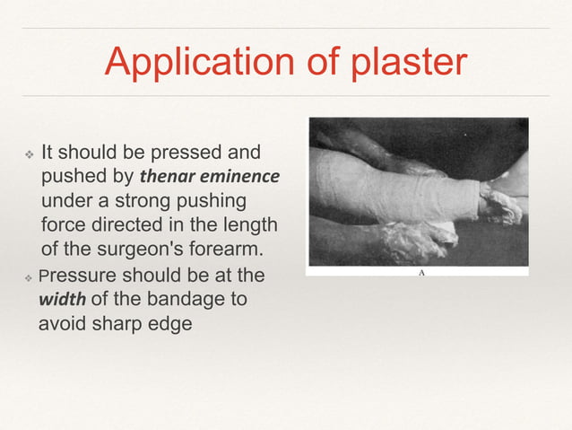 Plaster of paris in orthopaedics | PPSX